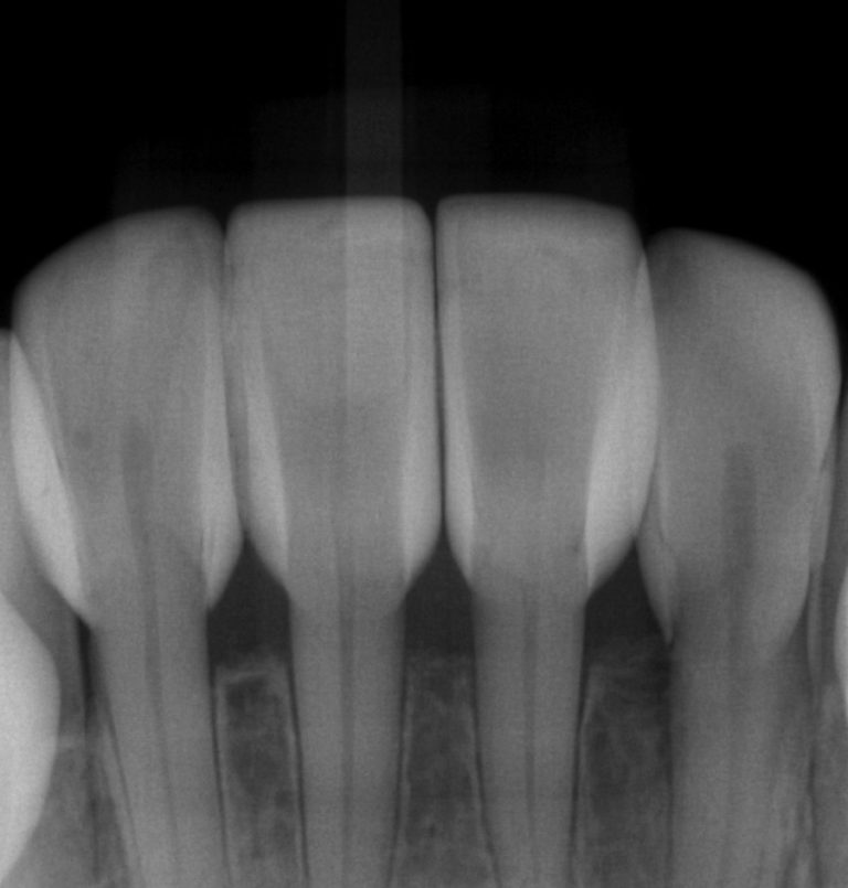 Treating The Black Triange With The Bioclear Method - Oral Health Group