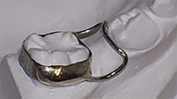 Space Maintainers Made Easy - Oral Health Group