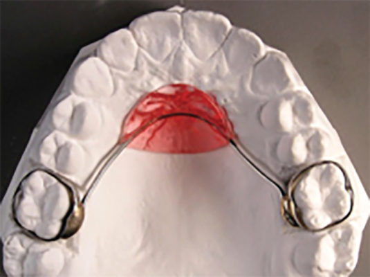 Space Maintainers Made Easy - Oral Health Group