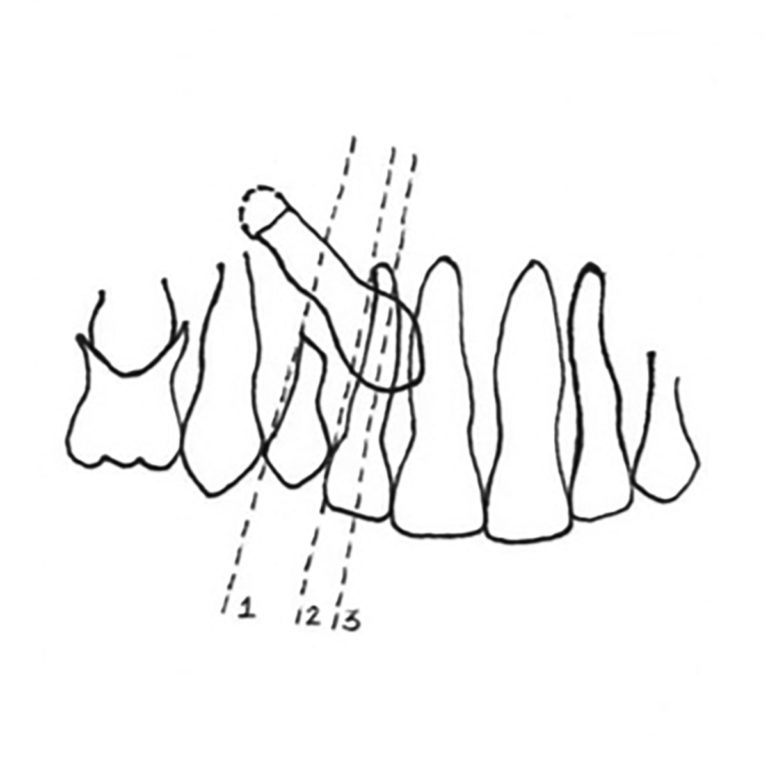 Early Intervention of Palatally Impacted Canines - Oral Health Group