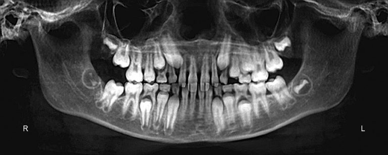 Early Intervention of Palatally Impacted Canines - Oral Health Group