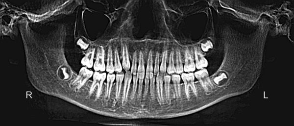 Early Intervention of Palatally Impacted Canines - Oral Health Group
