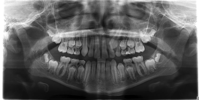 Early Intervention of Palatally Impacted Canines - Oral Health Group