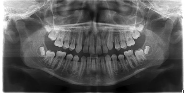 Early Intervention of Palatally Impacted Canines - Oral Health Group