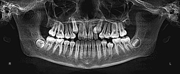 Early Intervention of Palatally Impacted Canines - Oral Health Group