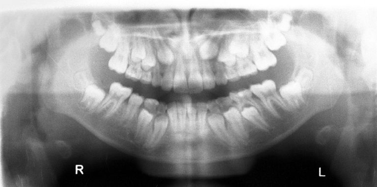 Early Intervention of Palatally Impacted Canines - Oral Health Group