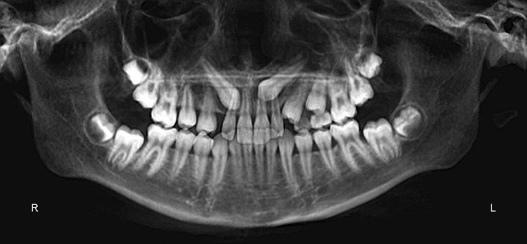 Early Intervention of Palatally Impacted Canines - Oral Health Group