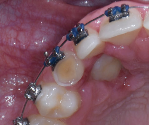 Early Intervention of Palatally Impacted Canines - Oral Health Group