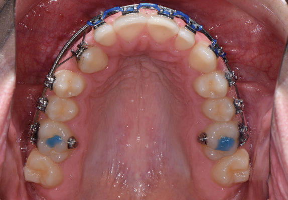 Early Intervention of Palatally Impacted Canines - Oral Health Group