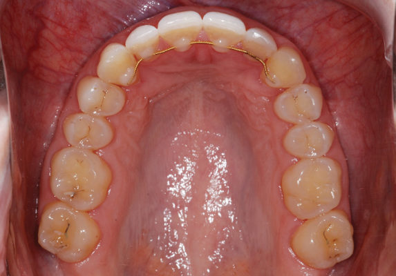 Early Intervention of Palatally Impacted Canines - Oral Health Group