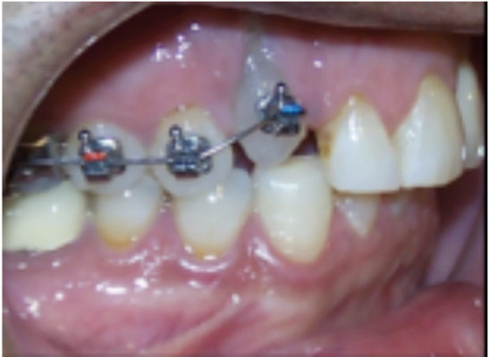 Braces and Invisalign In Pre-Prosthetic Orthodontics - Oral Health Group