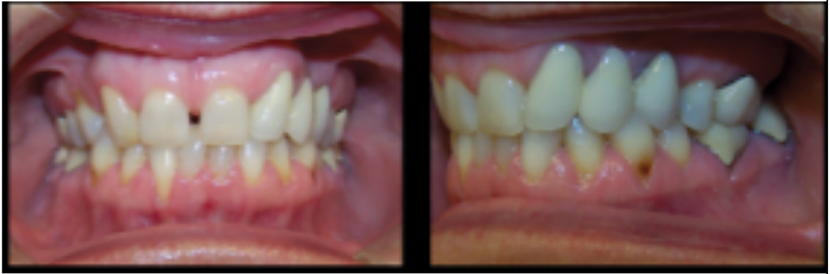 Braces and Invisalign In Pre-Prosthetic Orthodontics - Oral Health Group