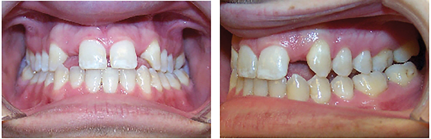 Braces and Invisalign In Pre-Prosthetic Orthodontics - Oral Health Group