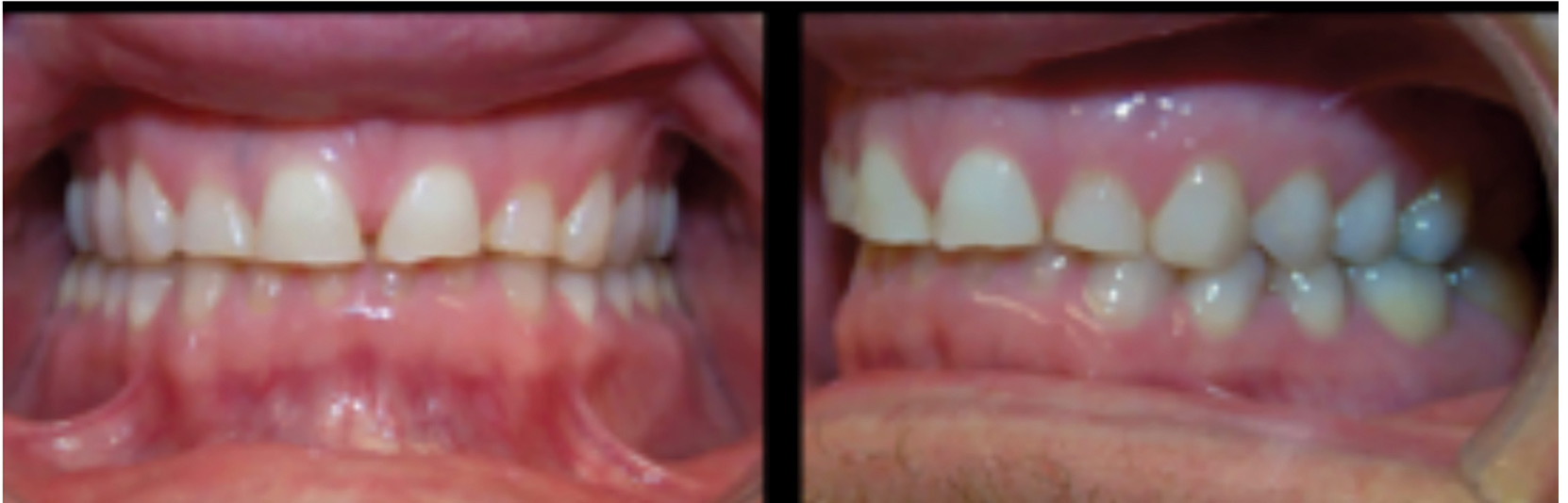 Braces and Invisalign In Pre-Prosthetic Orthodontics - Oral Health Group