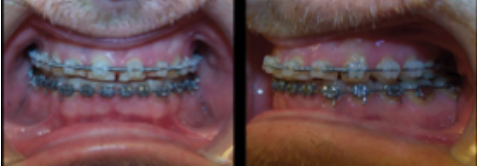 Braces and Invisalign In Pre-Prosthetic Orthodontics - Oral Health Group