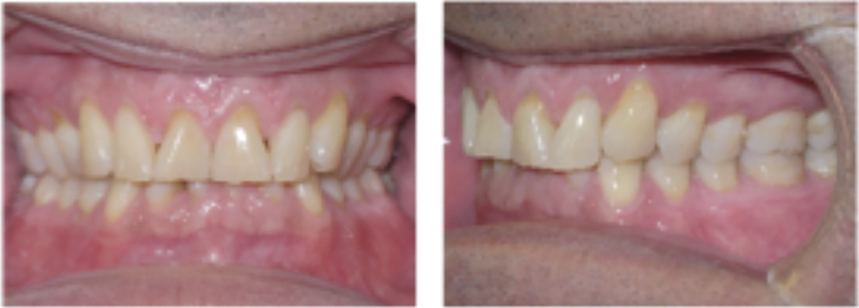Braces and Invisalign In Pre-Prosthetic Orthodontics - Oral Health Group