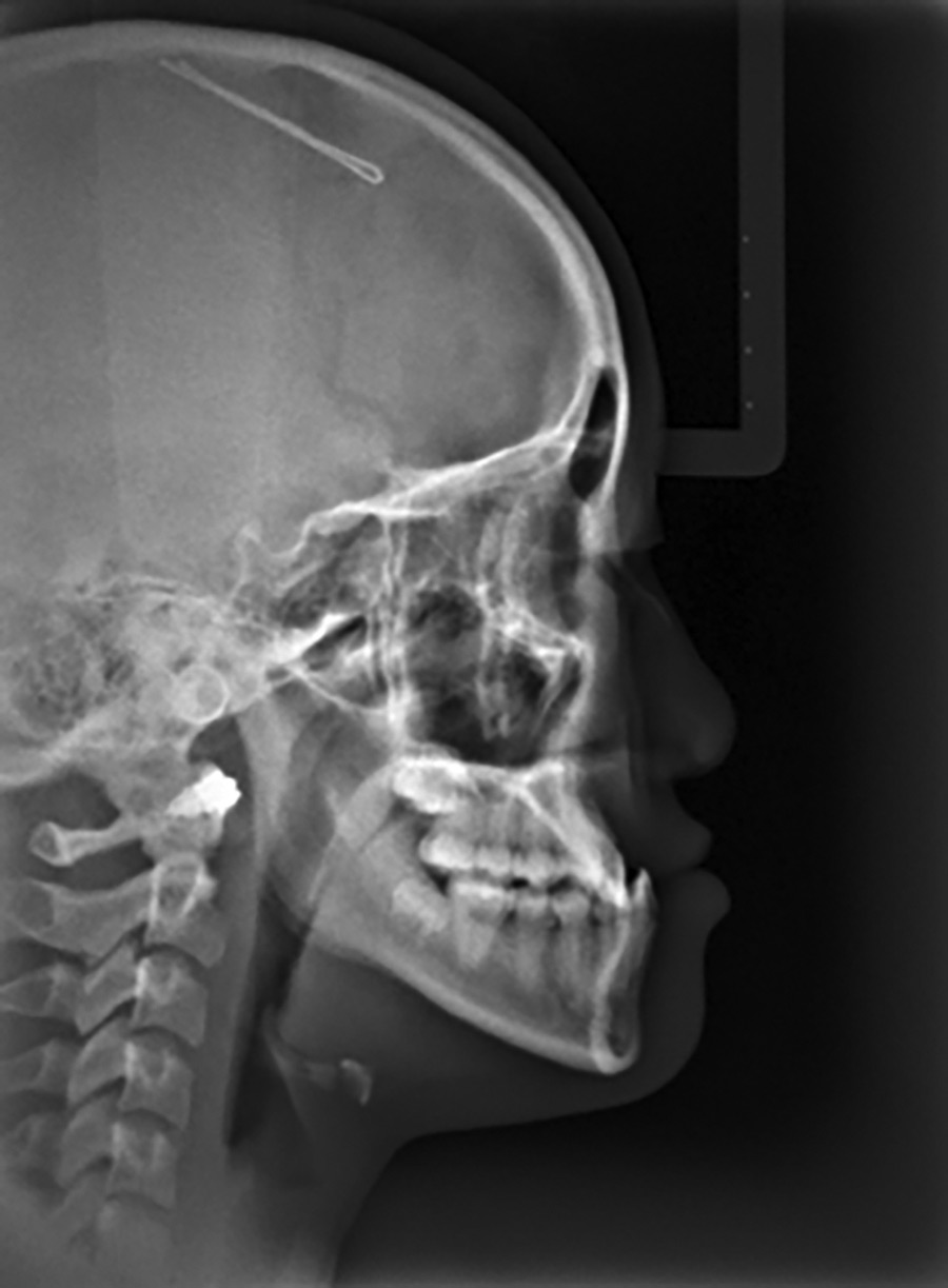 Non-Surgical Compensation Of Skeletal Class III Malocclusions - Oral ...