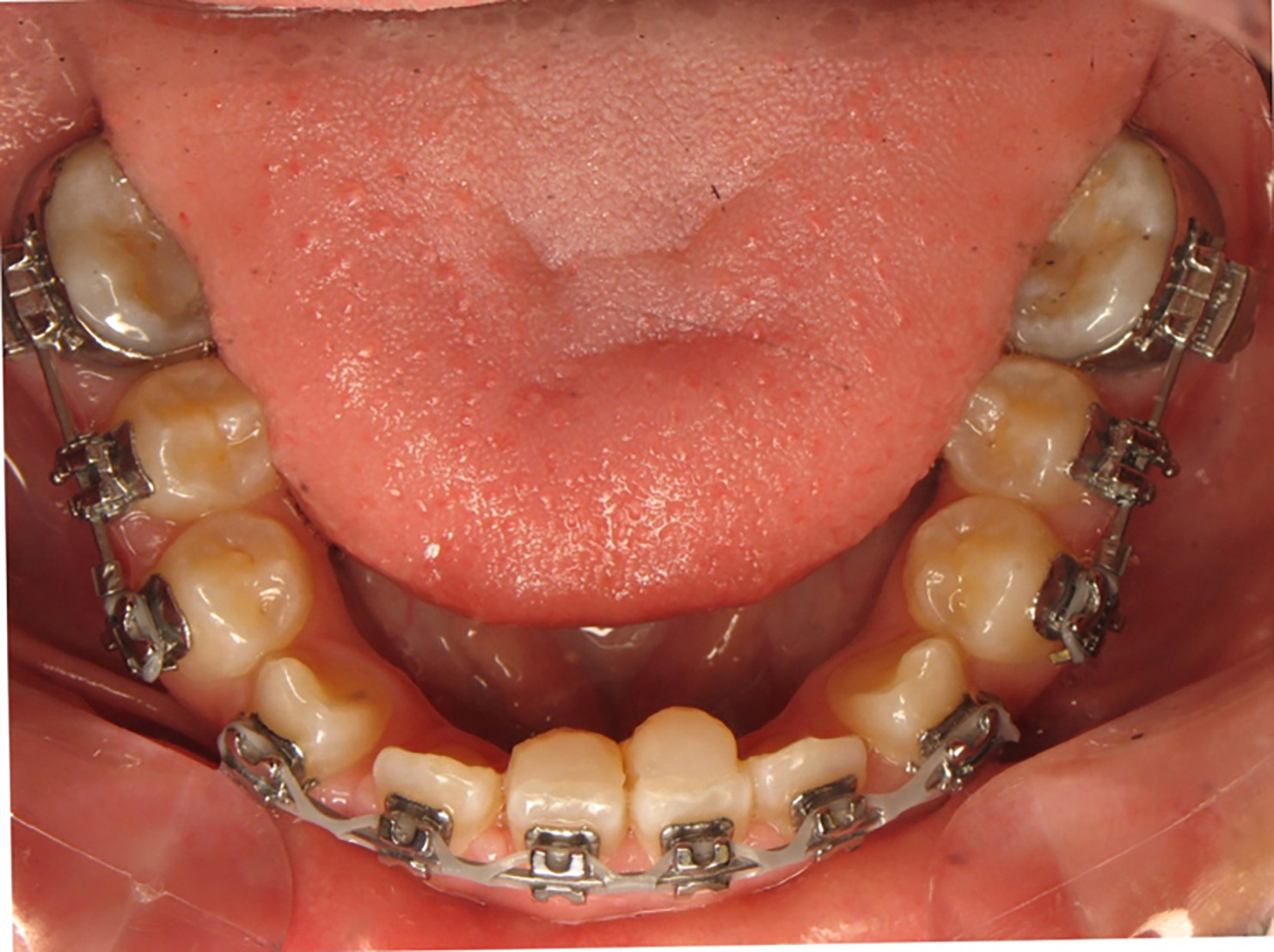 Non-Surgical Compensation Of Skeletal Class III Malocclusions - Oral ...
