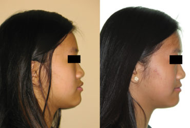 Non-Surgical Compensation Of Skeletal Class III Malocclusions - Oral ...