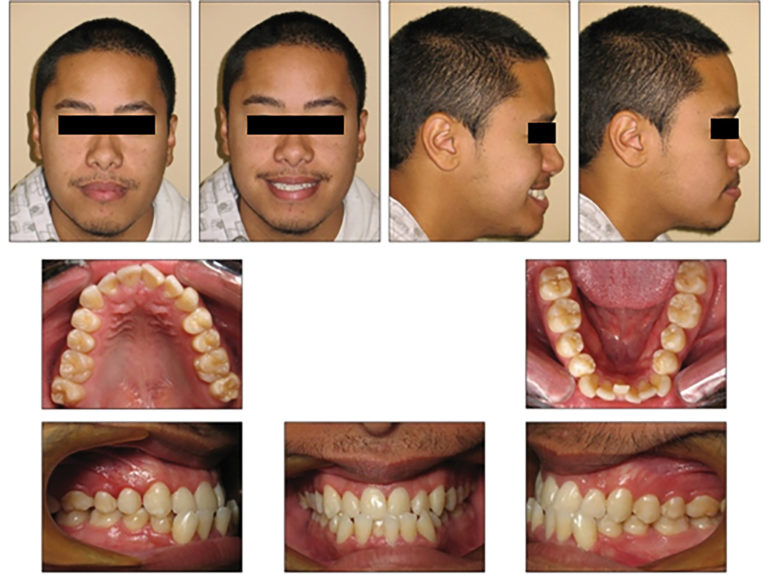 Non-Surgical Compensation Of Skeletal Class III Malocclusions - Oral ...
