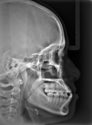 Non-Surgical Compensation Of Skeletal Class III Malocclusions - Oral ...