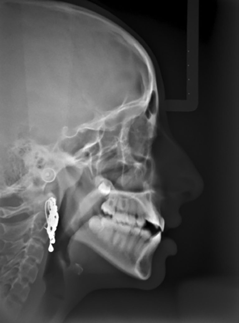 Non-Surgical Compensation Of Skeletal Class III Malocclusions - Oral ...