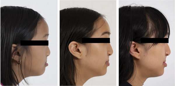 Orthodontic Treatments In Cleft Lip & Palate Patients - Oral Health Group