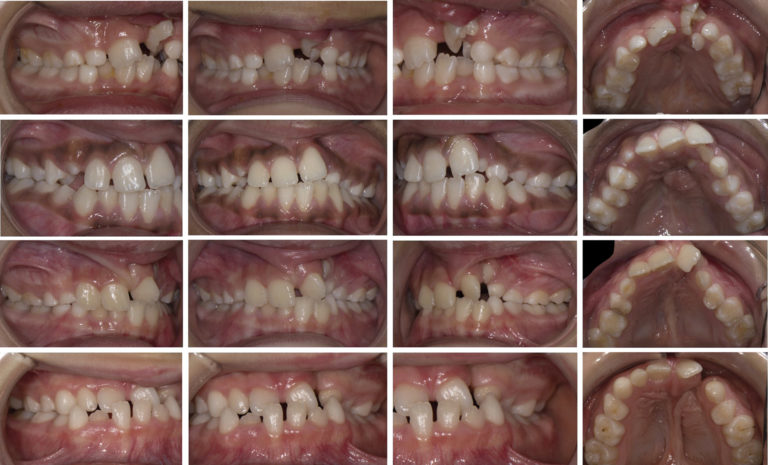 Orthodontic Treatments In Cleft Lip & Palate Patients - Oral Health Group
