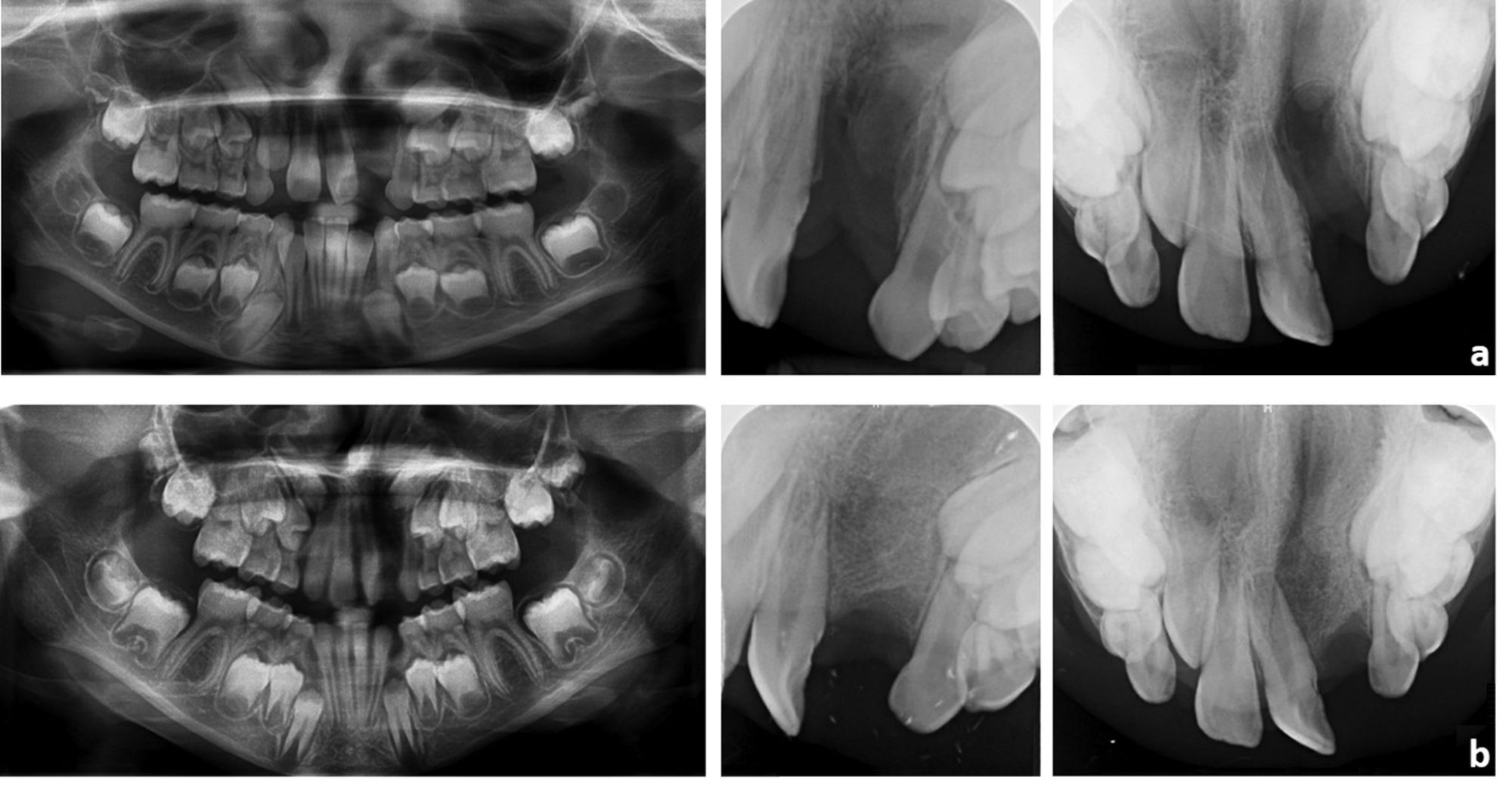 Orthodontic Treatments In Cleft Lip & Palate Patients - Oral Health Group
