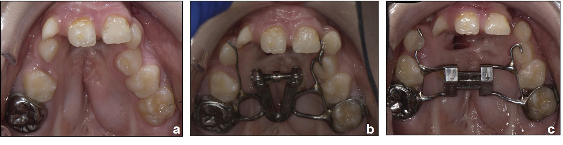 Orthodontic Treatments In Cleft Lip & Palate Patients - Oral Health Group