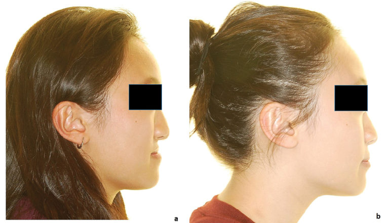 Orthodontic Treatments In Cleft Lip & Palate Patients - Oral Health Group