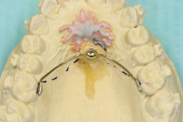 Palatal MSI: Safe, Versatile, Easy - Oral Health Group