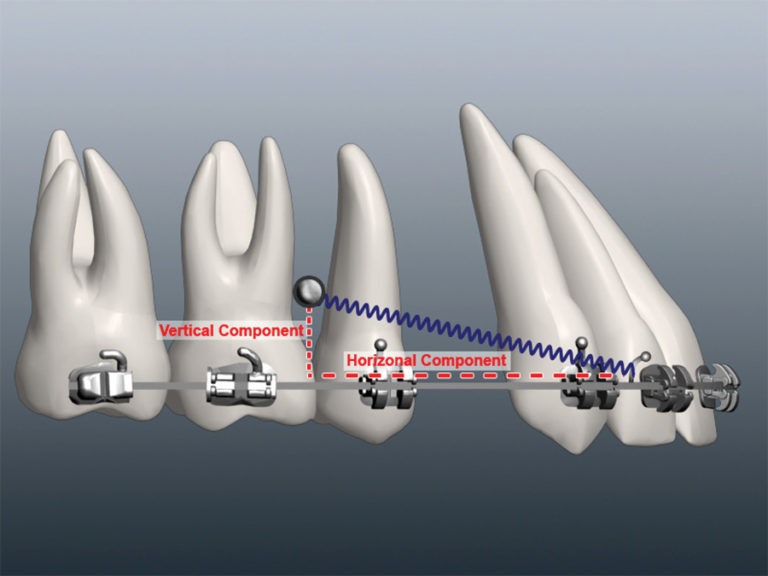 Palatal MSI: Safe, Versatile, Easy - Oral Health Group