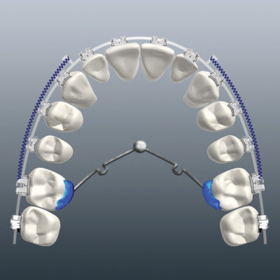 Palatal MSI: Safe, Versatile, Easy - Oral Health Group