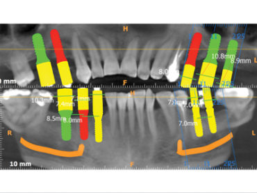 Periodontal And Prosthodontic Management Of Class III Malocclusion
