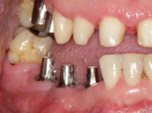 Periodontal And Prosthodontic Management Of Class III Malocclusion