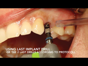 Guided Implantology: The SMART Guide - Oral Health Group