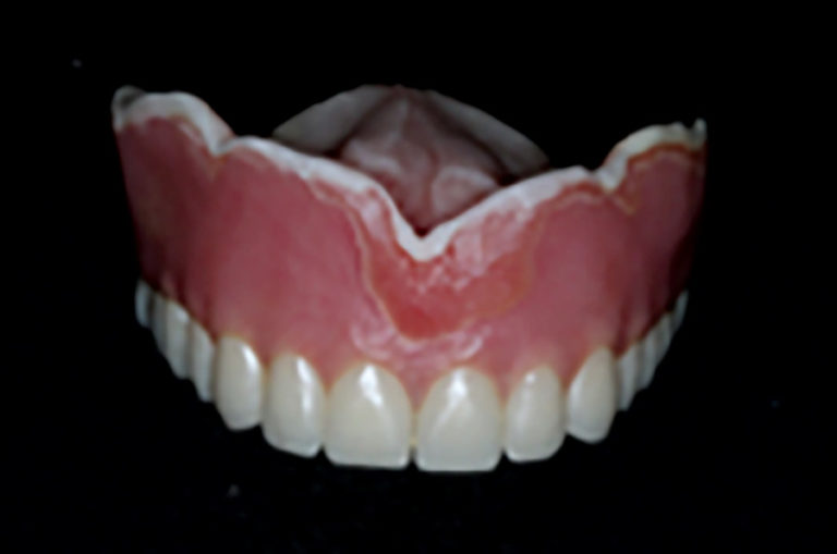 Transition From A Removable To A Fixed Implant-Supported Prosthesis