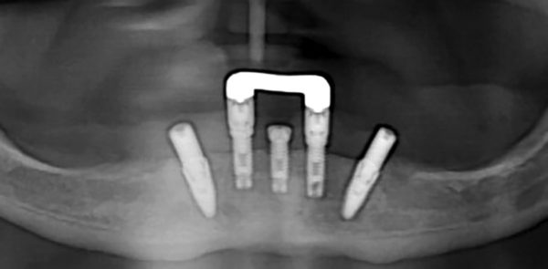 Transition From A Removable To A Fixed Implant-Supported Prosthesis