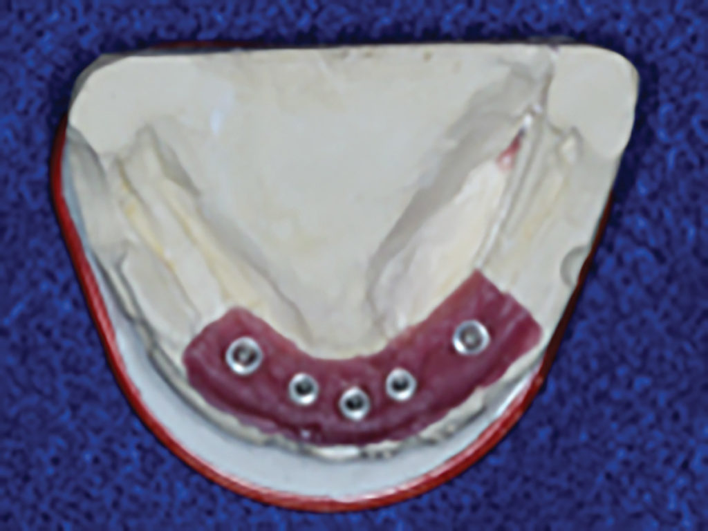 Transition From A Removable To A Fixed Implant-Supported Prosthesis