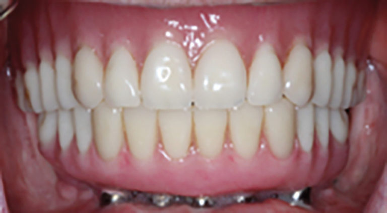 Transition From A Removable To A Fixed Implant-Supported Prosthesis