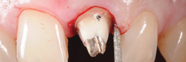 BOPT: For Sustainable Periodontal Health and Optimal Esthetics