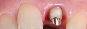 BOPT: For Sustainable Periodontal Health and Optimal Esthetics