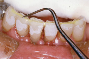 Fibre Reinforcing Composite Resins - Oral Health Group