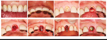 Partial Extraction Therapy: An Approach to Preserve the Buccal Plate ...