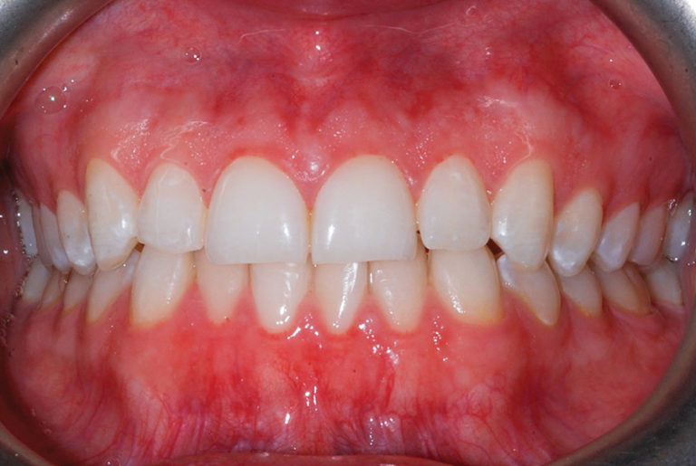 Setting The Stage For Porcelain Veneers - Oral Health Group