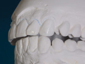 Case Study: Anterior Composite Rehabilitation: A Minimally Invasive ...