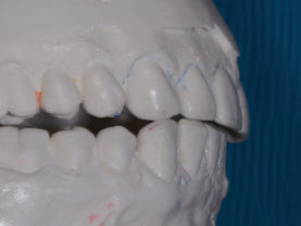 Case Study: Anterior Composite Rehabilitation: A Minimally Invasive ...