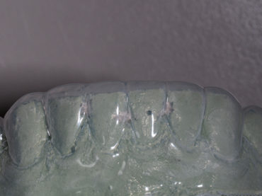 Case Study: Anterior Composite Rehabilitation: A Minimally Invasive ...
