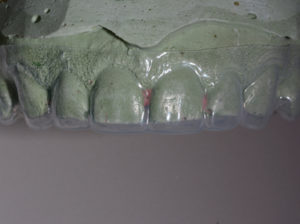 Case Study: Anterior Composite Rehabilitation: A Minimally Invasive ...